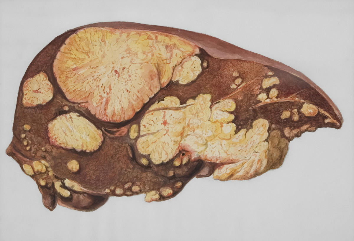 Liver Cancer Rates by Country 2026