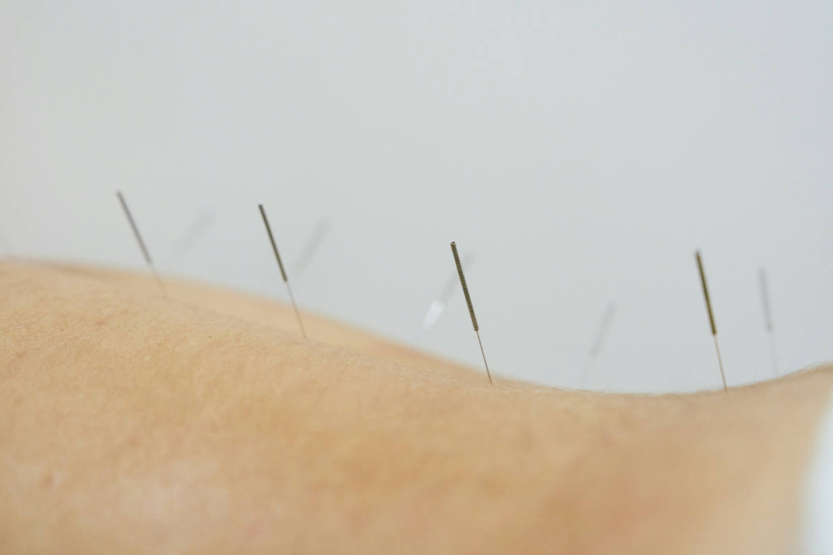 Dry Needling Legal States 2026